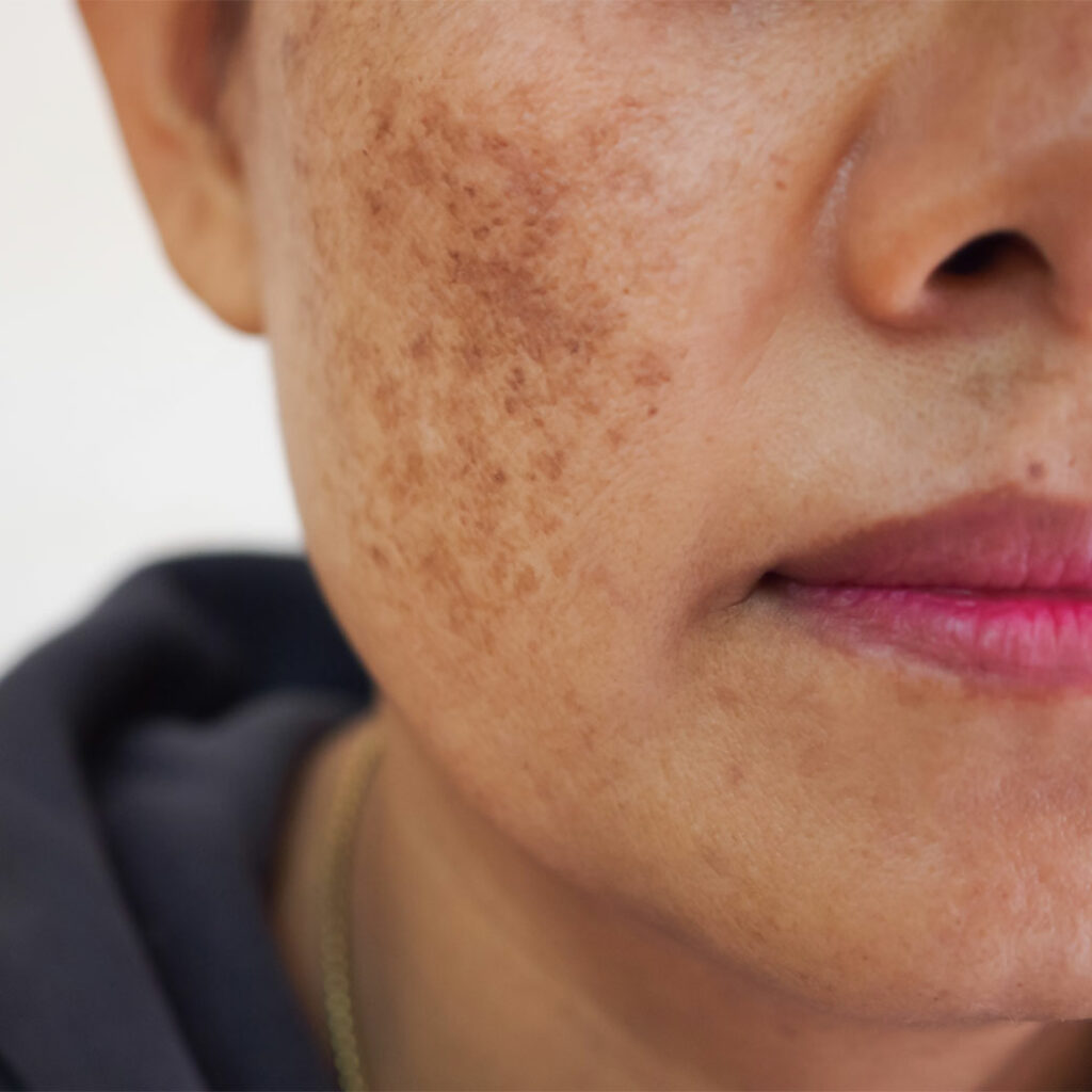 Dark Spots – Dr. Rabi Dermatology