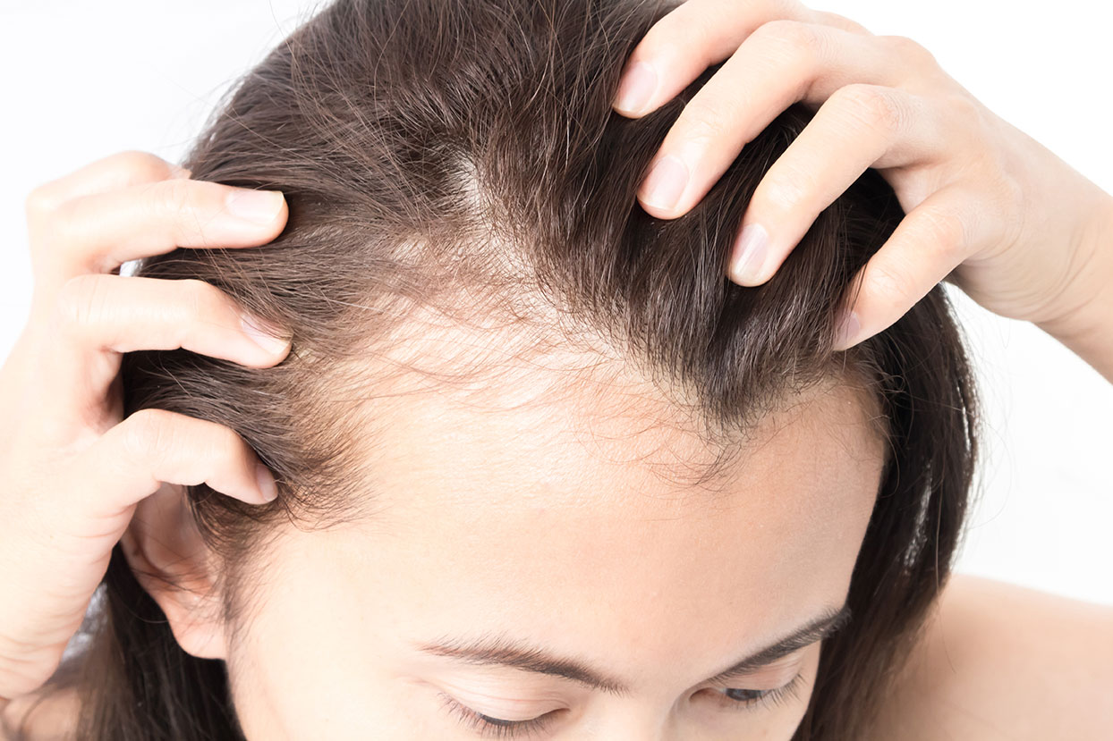 Alopecia Areata - Dr. Rabi Dermatology