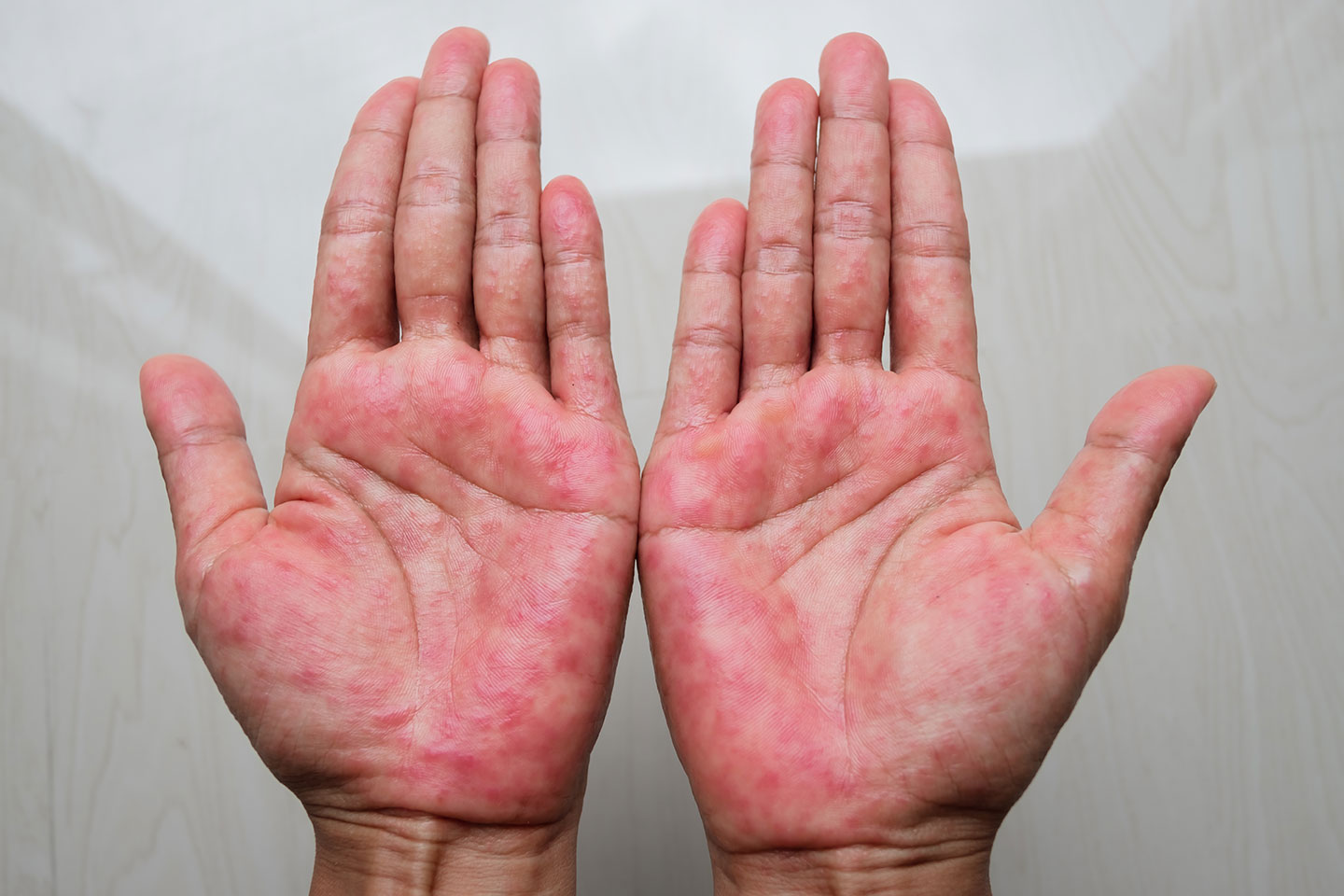 Hand Dermatitis - Dr. Rabi Dermatology